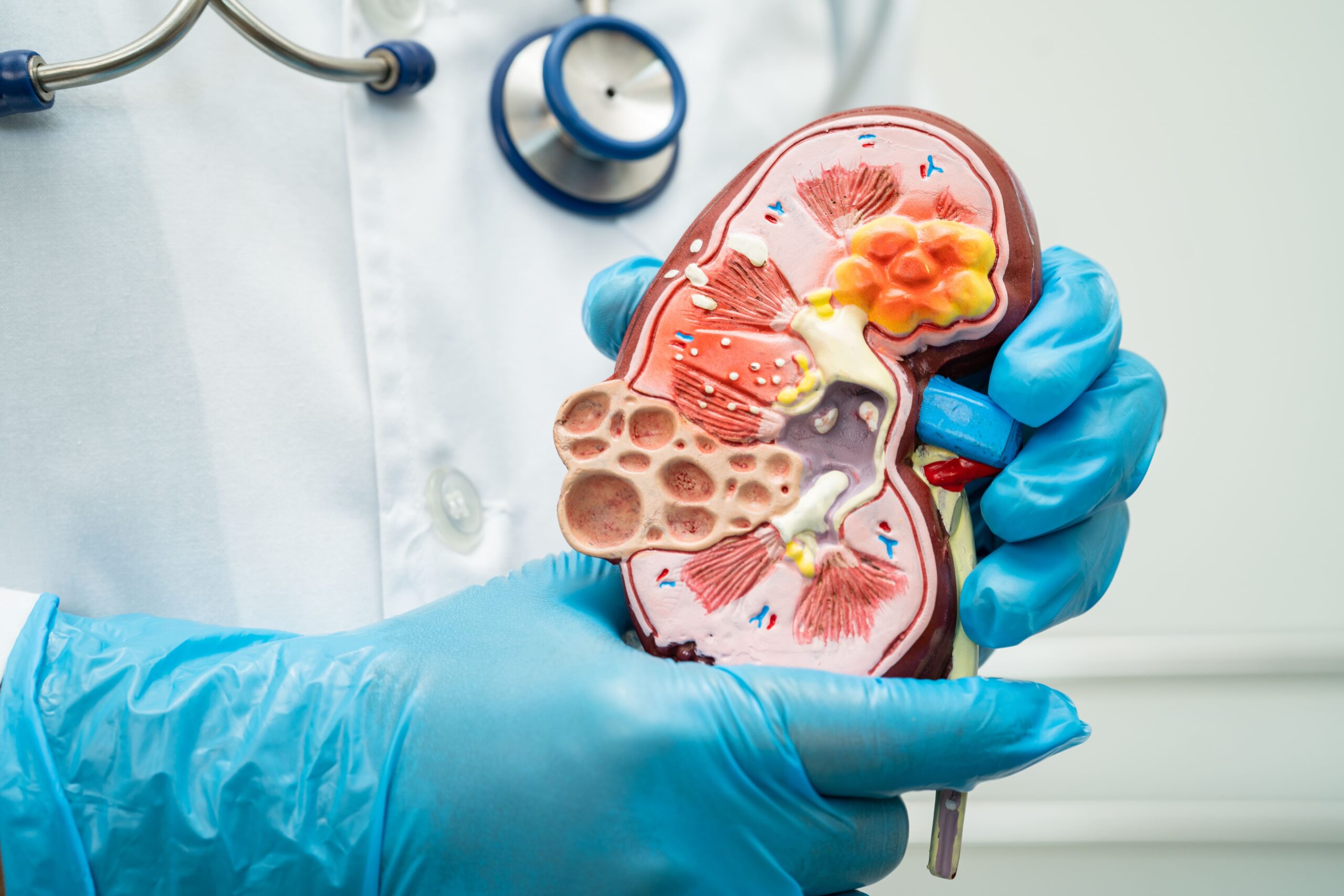 Radical Nephrectomy Surgery in Singapore | Kidney Removal
